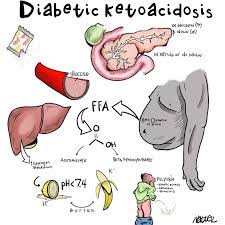 Diabetic Ketoacidosis A Guide to Symptoms, and more