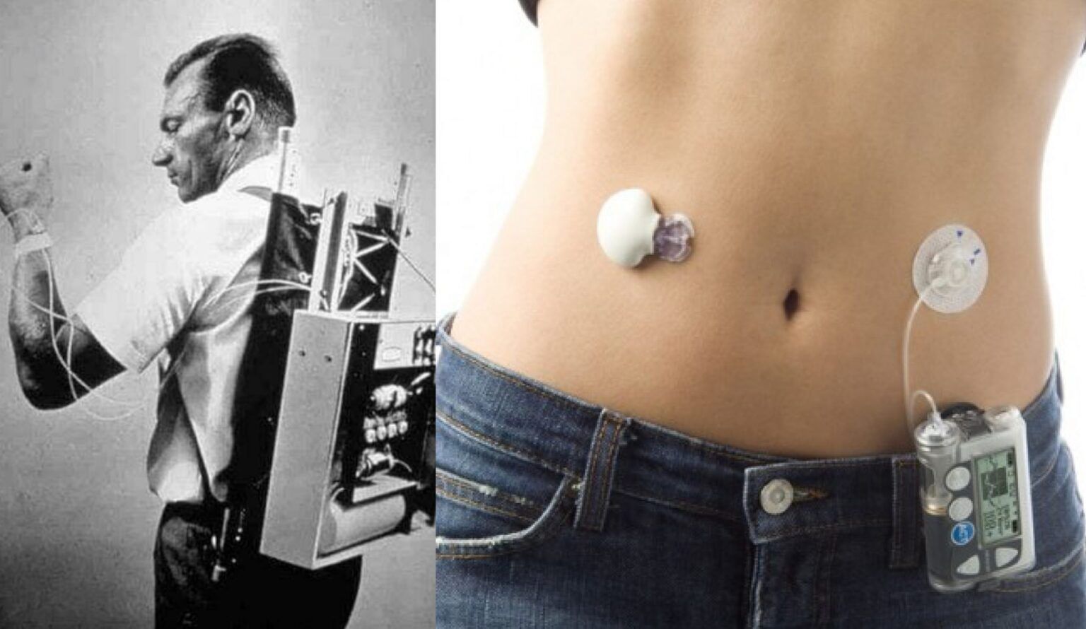 The Evolution of Insulin Delivery Devices